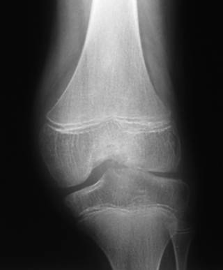 Hemophilic Arthropathy - Basic Science - Orthobullets
